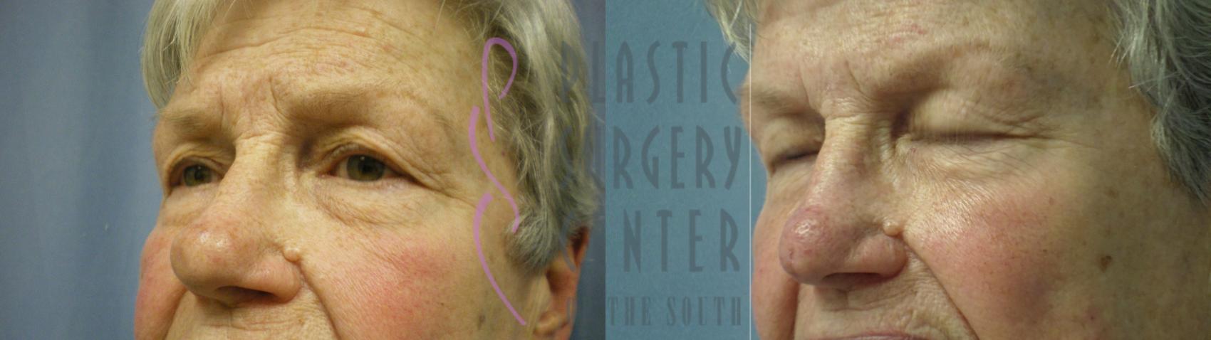 Skin Cancer Reconstruction Before & After Photos Patient 210 | Atlanta ...